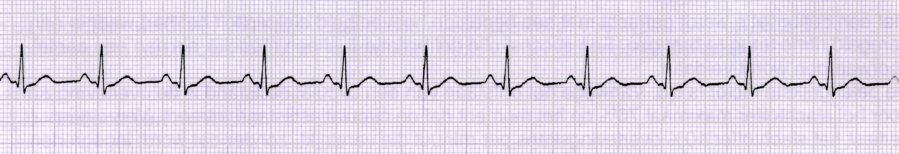 Werking AED | Stichting Sint Anthonis HartVeilig