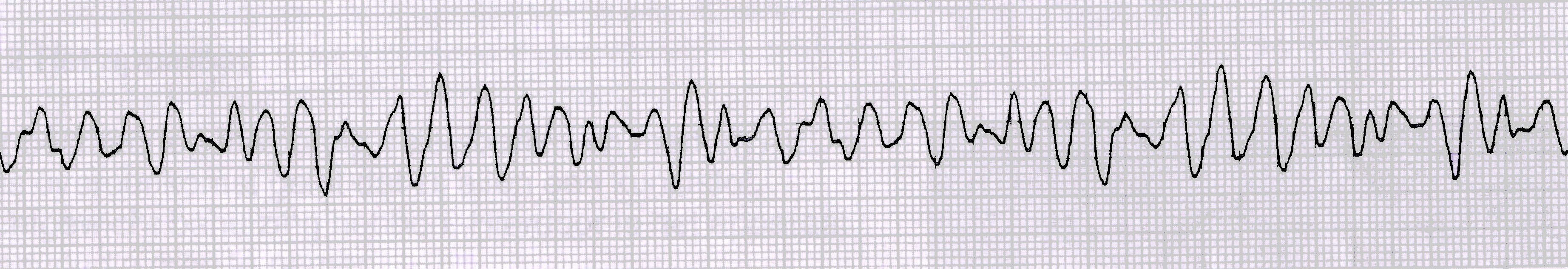 Werking AED | Stichting Sint Anthonis HartVeilig