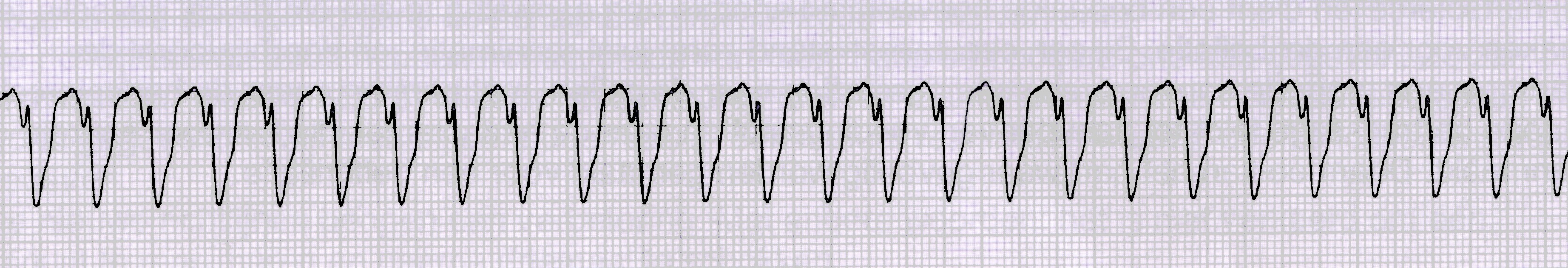 Werking AED | Stichting Sint Anthonis HartVeilig